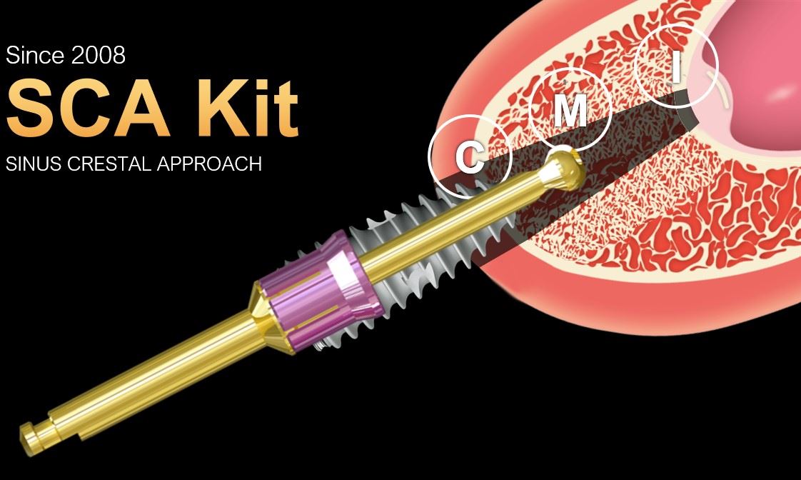 許永九博士的上顎竇人工植牙微創手術