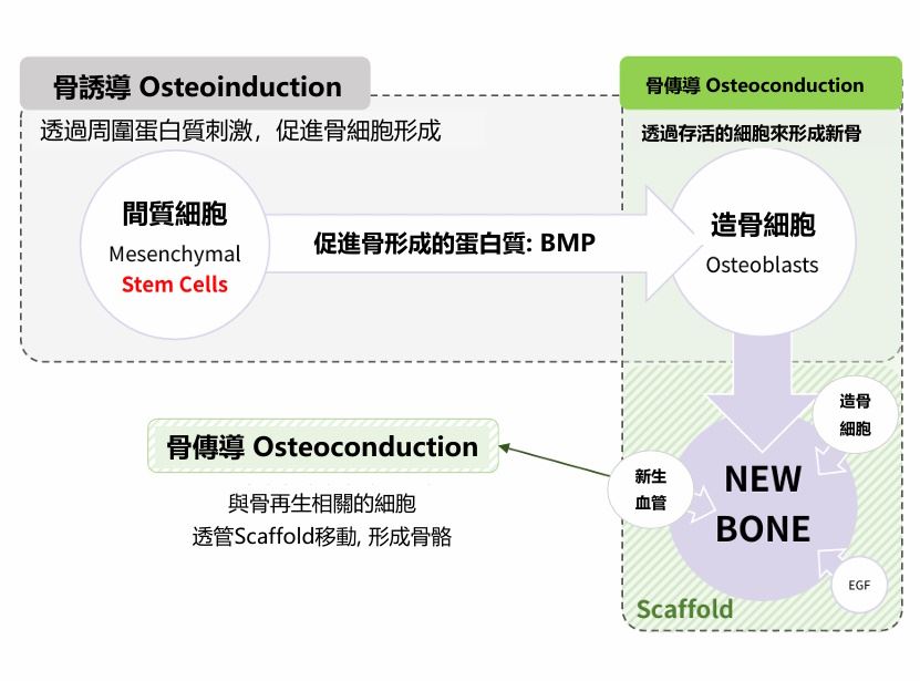 SureOss 骨粉 - 促進新骨形成的高品質一次性包裝FDBA骨粉